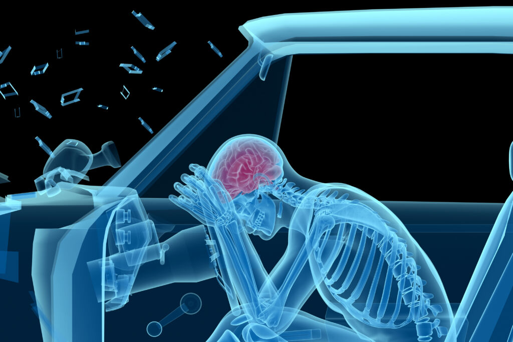 Symptoms of Internal Bleeding After a Car Accident